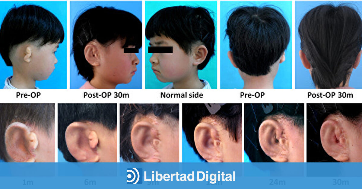 Logran que a cinco niños les crezcan orejas nuevas - Libertad Digital