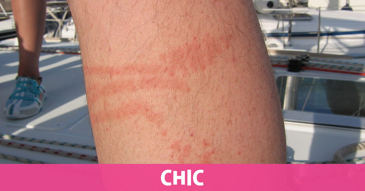 ¿Cómo aliviar el picor de una picadura de medusa?